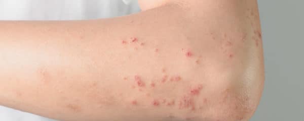 Causes Of Itchy Red Bumps On The Skin Skin Care Research